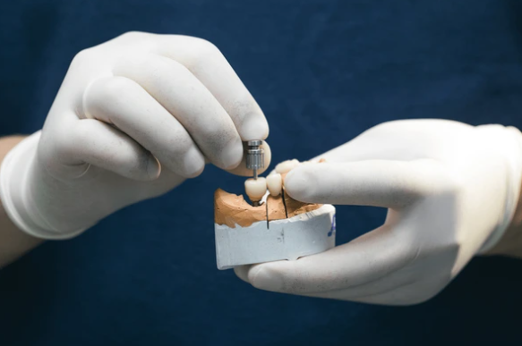 A Clinician’s Guide to the Alfa Gate Screw-Retained Abutment – alfa-gate